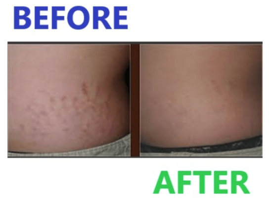 invisa-RED™ Weight Loss in Tulsa OK | Keith G. Ryan Chiropractic